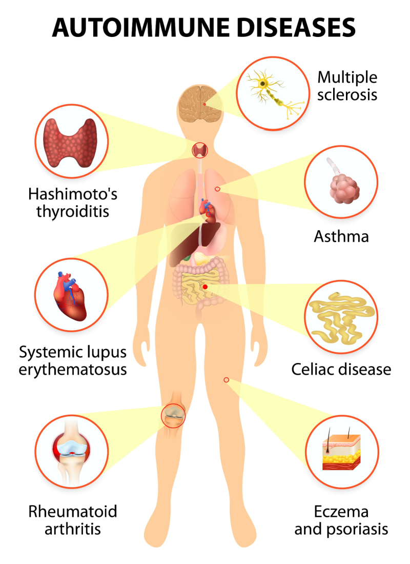 Exploring the Link Between Lyme Disease and Autoimmune Disorders