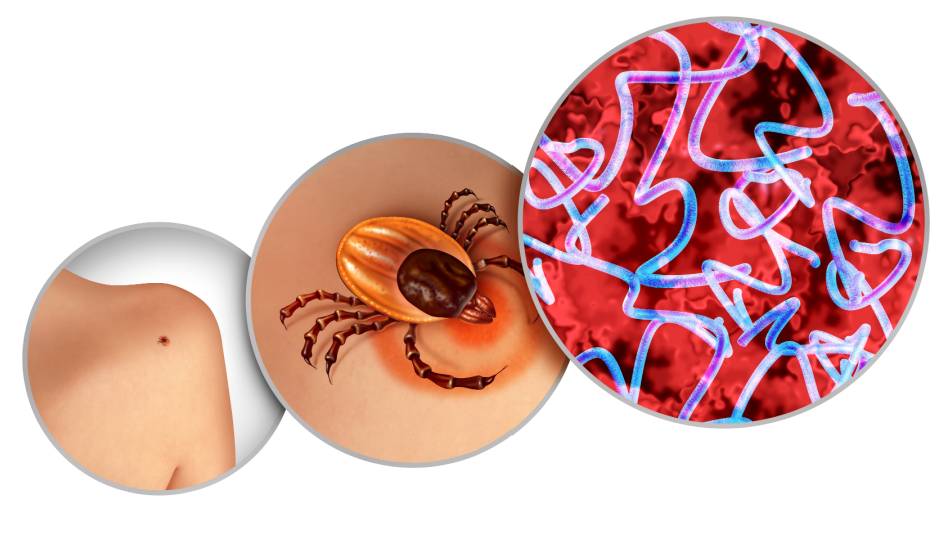 The Link Between Tick Bites & Autoimmune Diseases: What You Need to Know